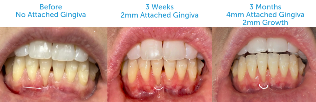 Ultimate Gingival Filler Course – Gum Builder and Treating Black ...