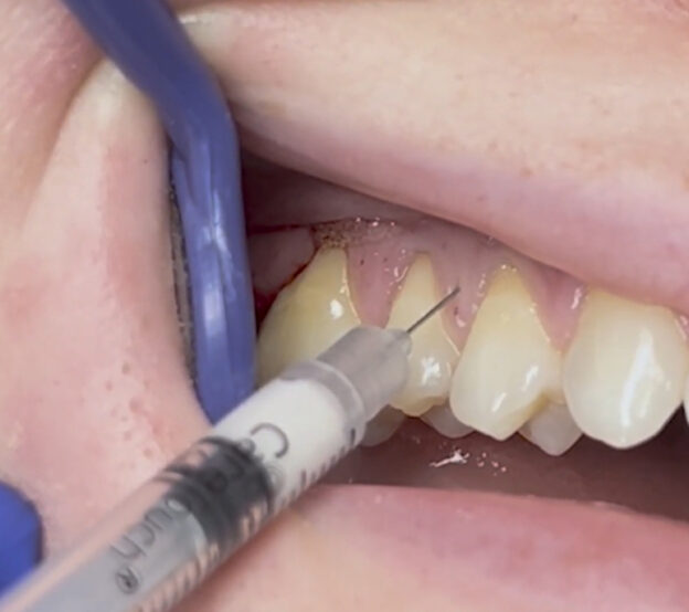 Ultimate Gingival Filler Course – Gum Builder and Treating Black ...